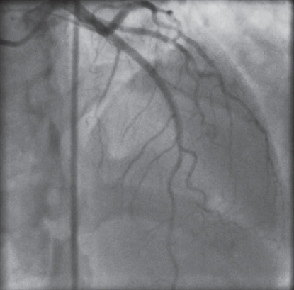 The Case of Spontaneous Coronary Artery Dissection | Consultant360