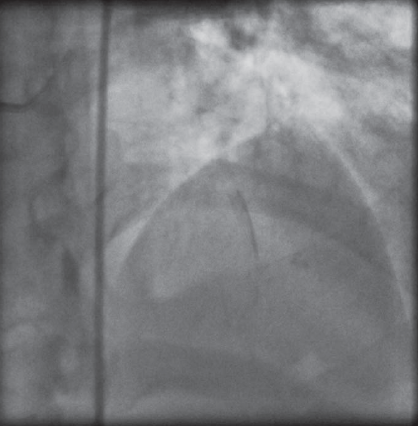 The Case of Spontaneous Coronary Artery Dissection | Consultant360