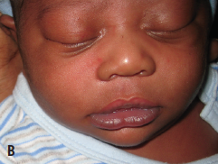 Neonatal Asymmetric Crying Facies | Consultant360