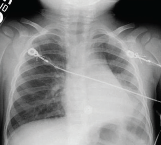Foreign Body Aspiration: 2 Cases | Consultant360