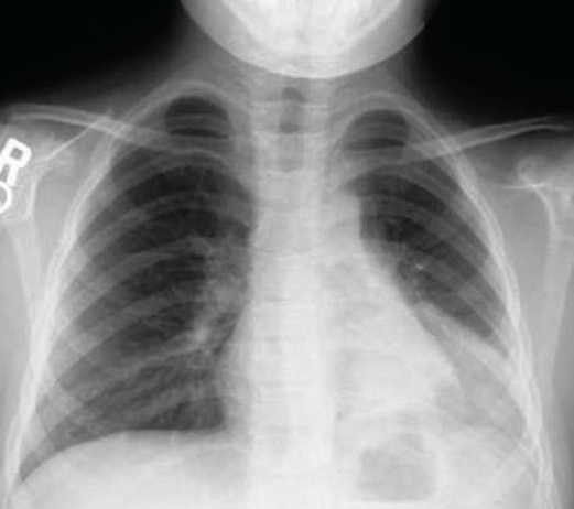 Foreign Body Aspiration: 2 Cases | Consultant360