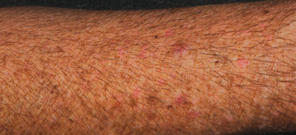 What is responsible for a two-day rash on his hands and arms ...