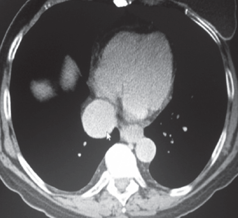 An Unusual Case of a Retrocardiac Mass | Consultant360