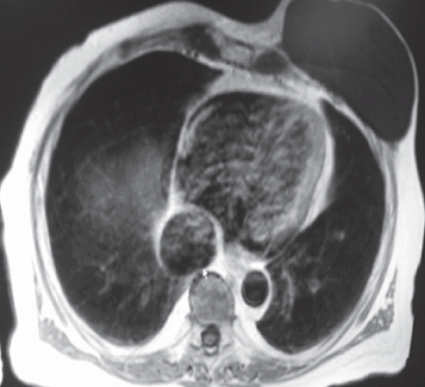 An Unusual Case of a Retrocardiac Mass | Consultant360