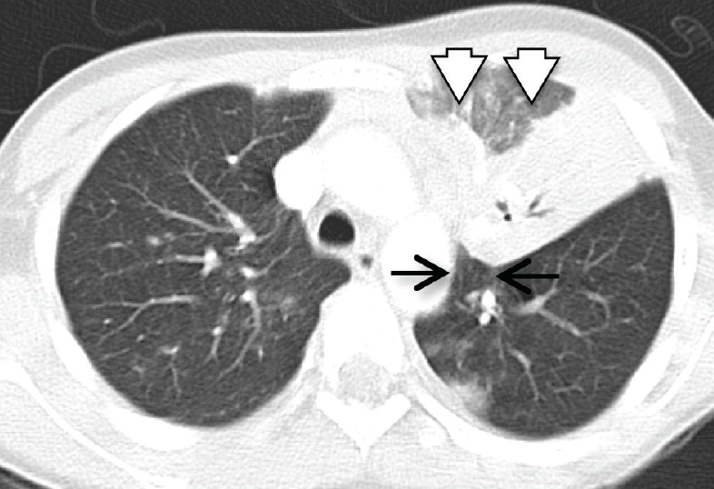 A 9-Year-Old Girl With Fever and Cough | Consultant360