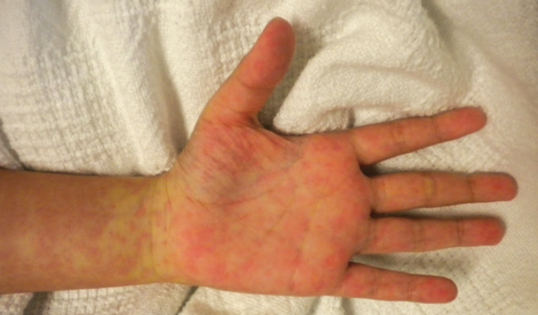 Hemophagocytic Syndrome Caused by Mycoplasma pneumoniae | Consultant360