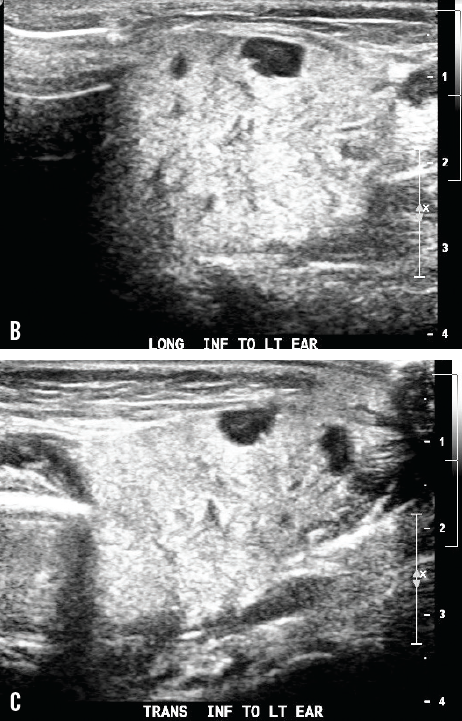Left Acute Viral Parotitis | Consultant360