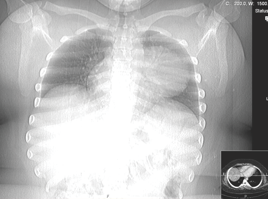 Pericardial Cyst | Consultant360