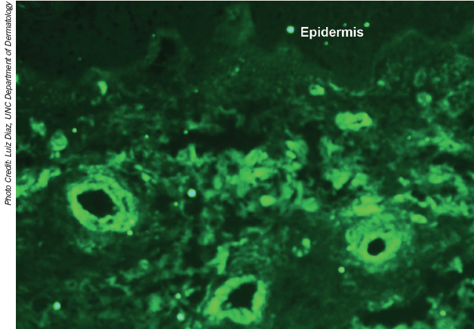When Weakness is More Than Deconditioning: ANCA-Associated Small-Vessel ...