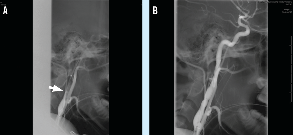 Arterial Ischemic Stroke in a 15-Year-Old | Consultant360