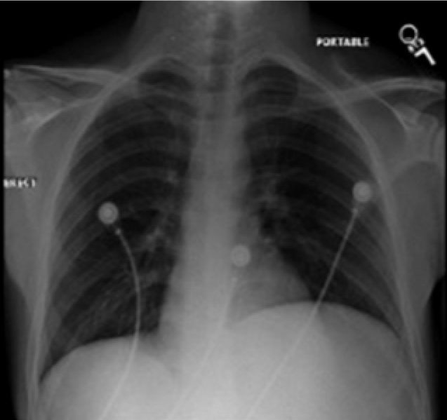 Ruptured Spleen X Ray