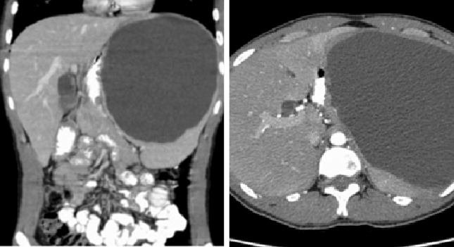 Massive Splenic Cyst Infected with Salmonella Saintpaul | Consultant360