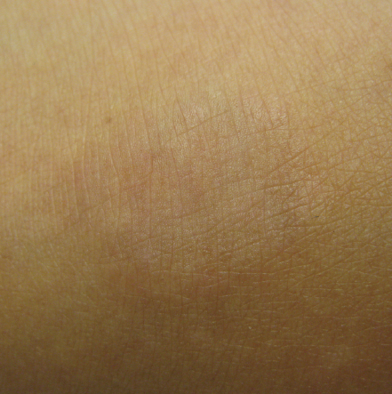 A Circular Lesion on the Back of the Foot | Consultant360