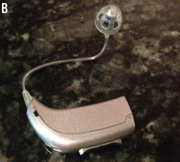 Retained Foreign Body in the Ear Canal | Consultant360