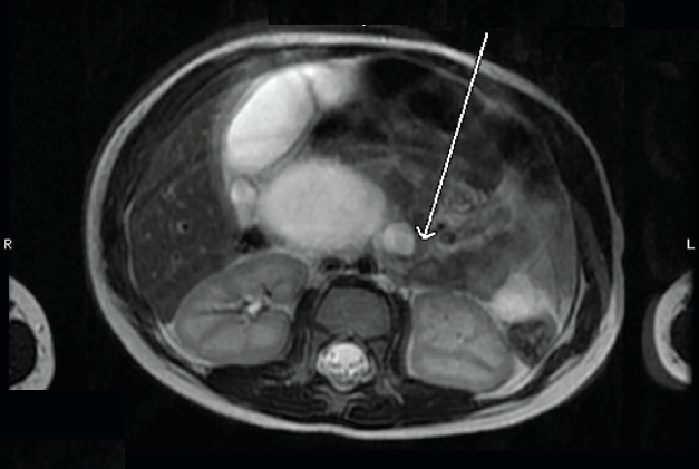 Biliary Cyst in a 16-Month-Old Girl With Constipation and Vomiting ...