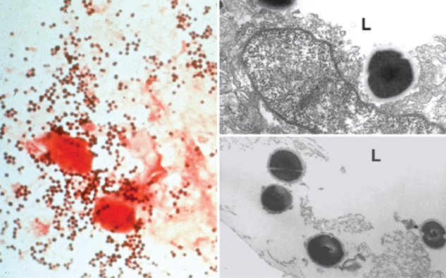 Community-Acquired MRSA: What You Need to Know | Consultant360