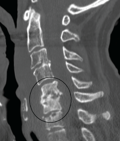 Lumbar Diskitis in a 20-Month-Old Boy | Consultant360