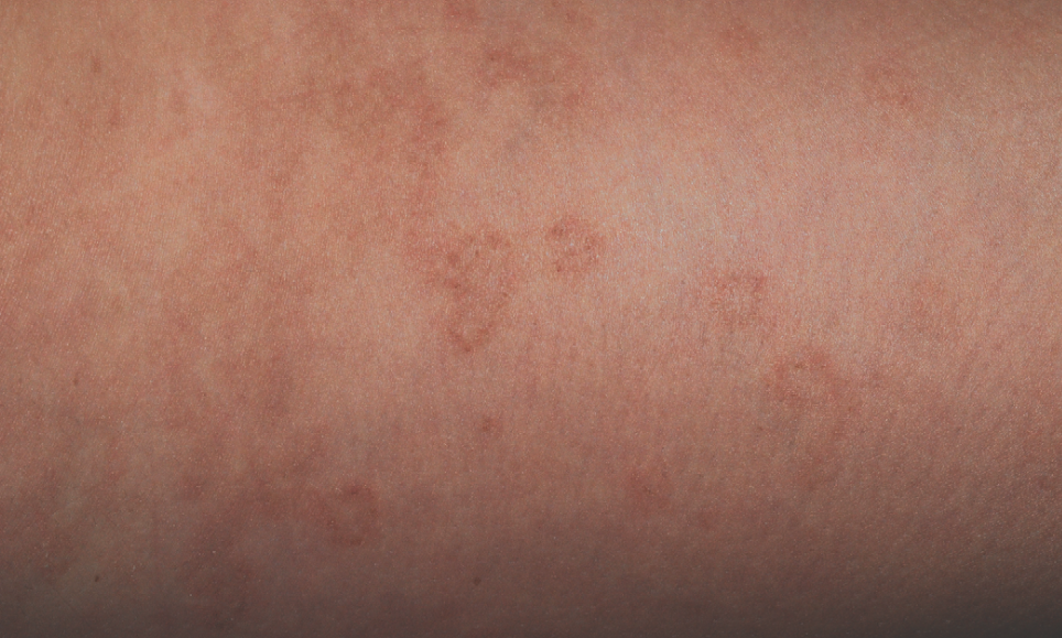 What is responsible for her new itchy rash? | Consultant360