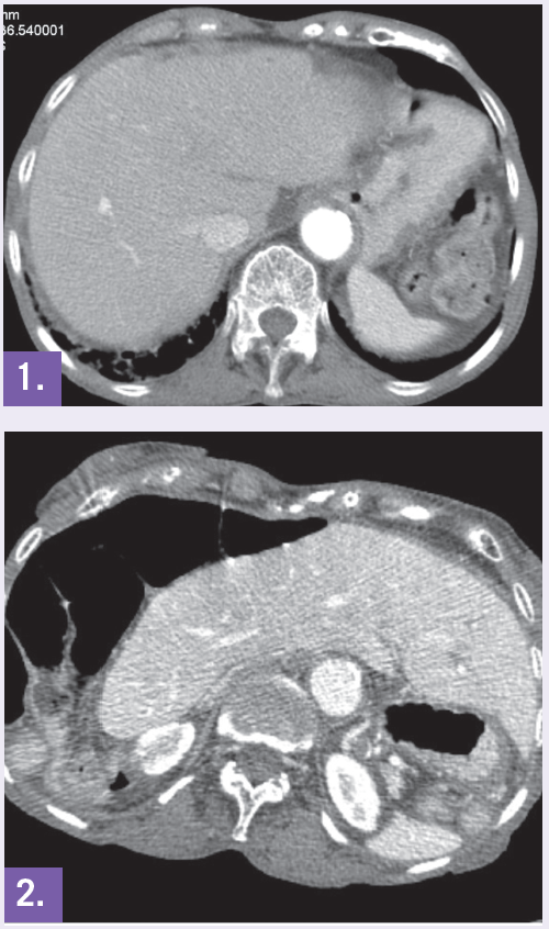 Chilaiditi Sign | Consultant360