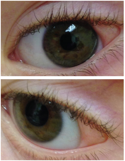 Lipodermoid | Consultant360