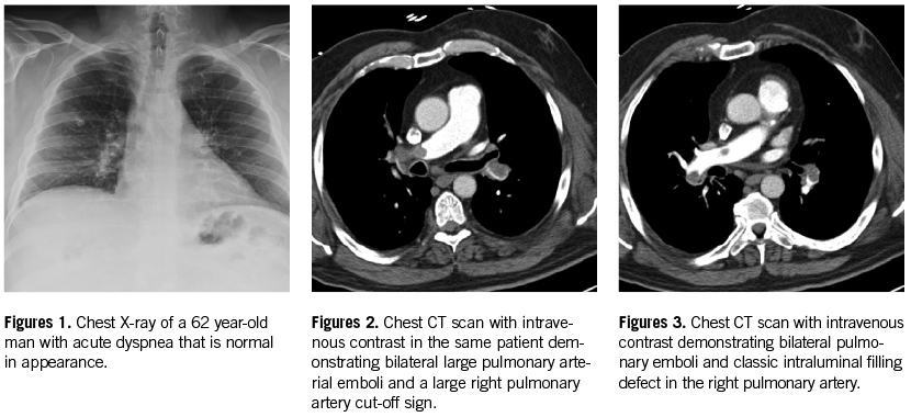 Pitfalls of Venous Thromboembolism | Consultant360