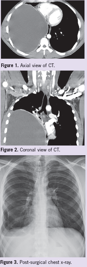 Pericardial Cyst | Consultant360