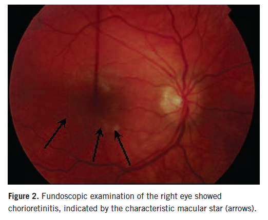 A Rash and “Brown Spots” in Vision: A Child With Cat-Scratch Disease ...