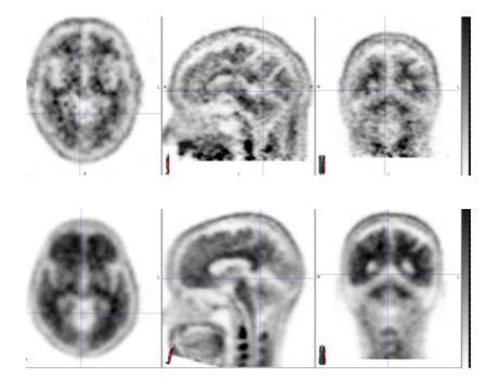 Evaluating Patients With Cognitive Changes: A New Imaging Option ...