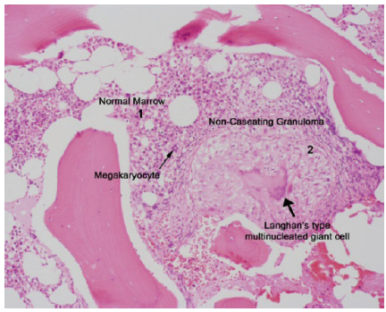 An Intriguing Granulomatous Uveitis Case | Consultant360