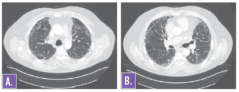 Pitfalls of Interstitial Lung Disease | Consultant360