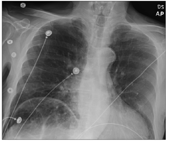 Patent Foramen Ovale with Platypnea-Orthodeoxia due to Colonic ...