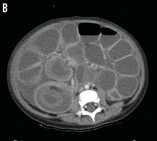 Ileoileal Intussusception With Severe Bruxism and Mandibular ...