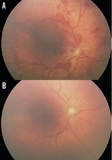 Spontaneous Resolution of Neonatal Retinal Hemorrhages | Consultant360