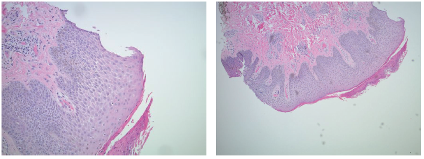 A Teenager With an Itchy, Round Rash Spreading Over Her Body ...