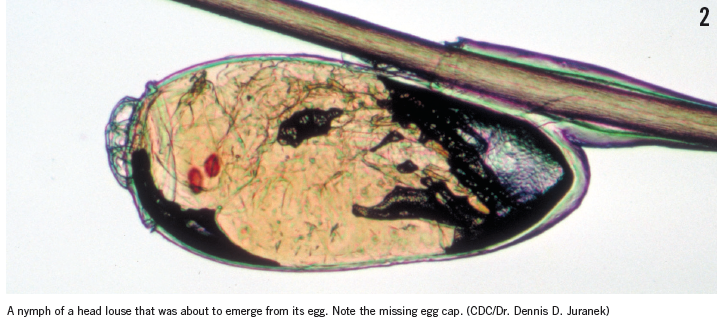 Pediculosis Diagnosis and Management: Advice for Educating About the ...
