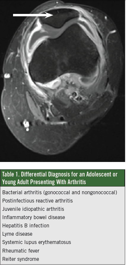 A Young Adult’s Knee Pain, Effusion, and Pyomyositis: What’s the Source ...