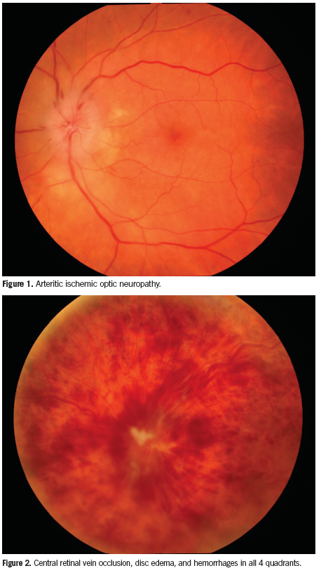 Preventing Permanent Vision Loss: The Diagnosis and Treatment of ...