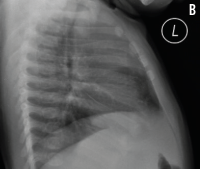 Peanut-Induced Anaphylaxis | Consultant360