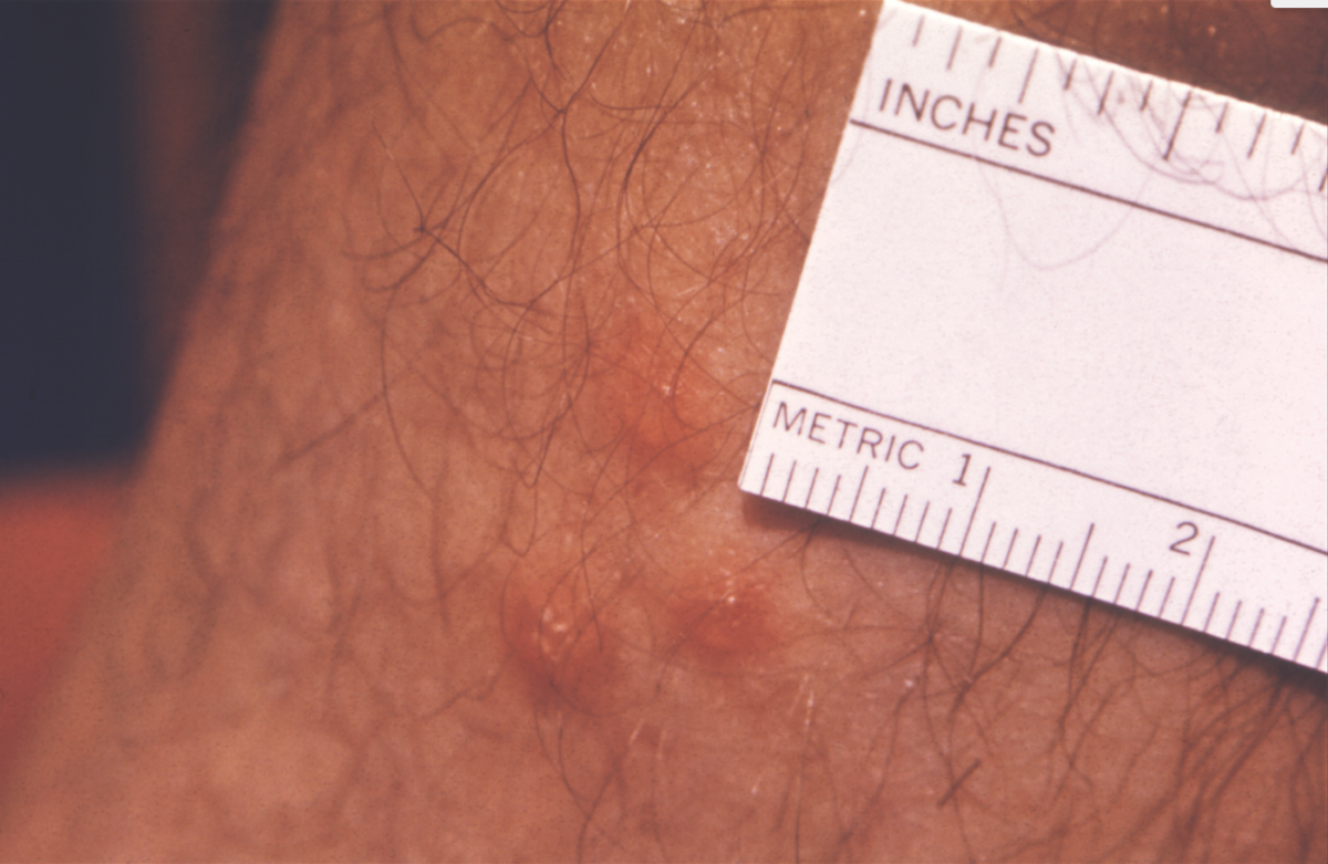 A Girl Returns From Summer Camp With an Itchy Rash: What’s the Cause ...