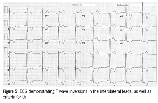 Apical Hypertrophic Cardiomyopathy | Consultant360