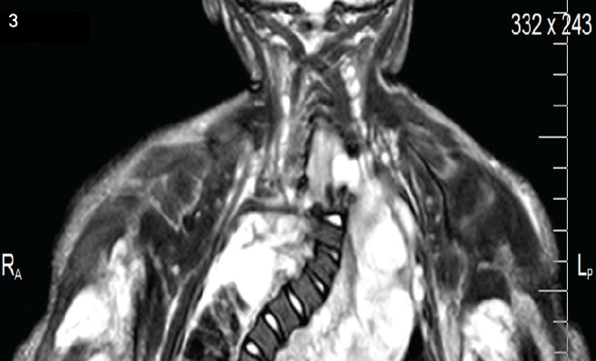 A Girl With Cerebriform Palmar Plaques | Consultant360