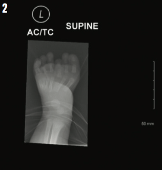 Fingers and Toes: Presentations of Polydactyly | Consultant360
