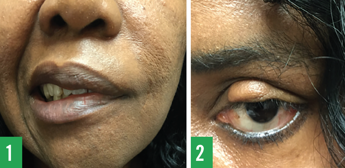 7th Cranial Nerve Palsy Facial Nerve Disorders The Aesthetic