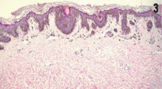 LEOPARD Syndrome: Progressively Increasing Pigmented Macules in an 8 ...