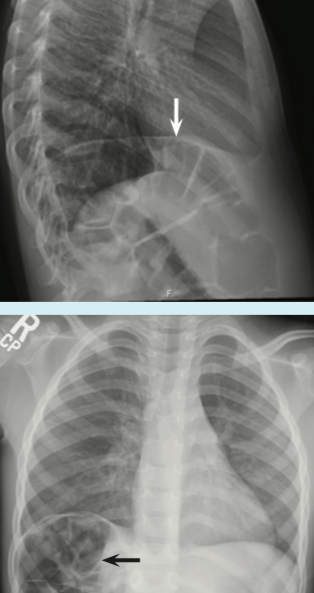 Chilaiditi Syndrome | Consultant360