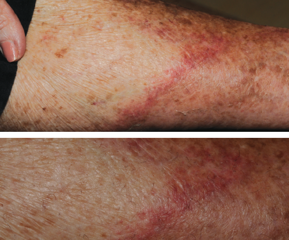 What is the cause of this woman’s lesions? | Consultant360