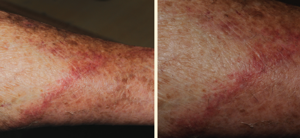 What is the cause of this woman’s lesions? | Consultant360