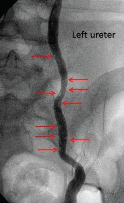 Ureteritis Cystica | Consultant360