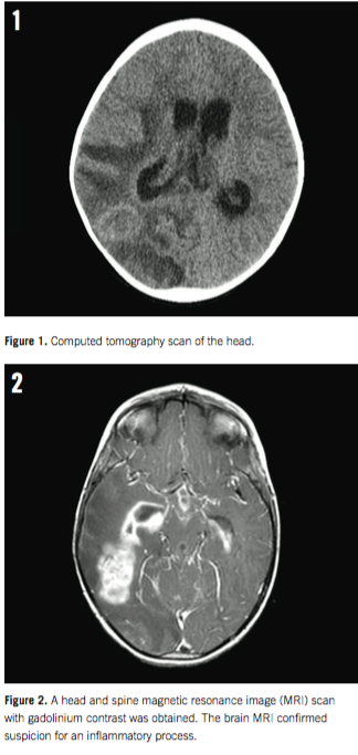 A Girl With Streptococcus dysgalactiae Brain Abscess and Meningitis | Consultant360