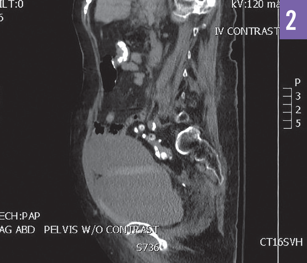 Intraparenchymal Hematoma Icd 10 Intraparenchymal Hematoma Icd 10
